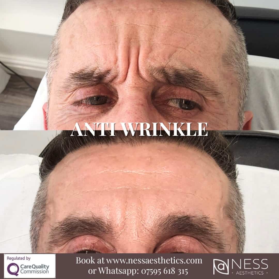 What are the best non surgical anti aging injections? - Ness Aesthetics