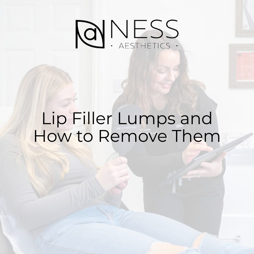 Lip Filler Lumps and How to Remove Them - Ness Aesthetics